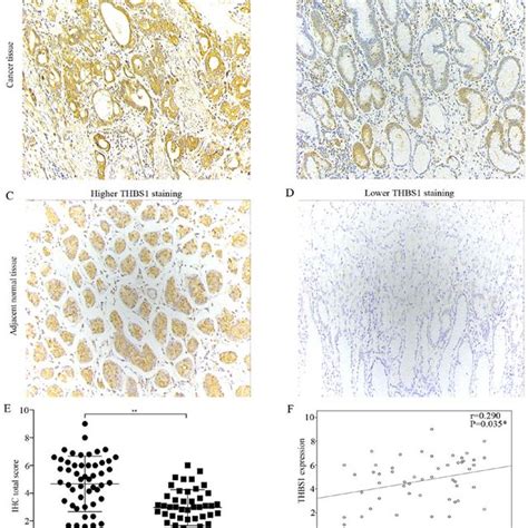 Expression Of Thbs1 In Paired Tumor And Adjacent Normal Tissues And Download Scientific