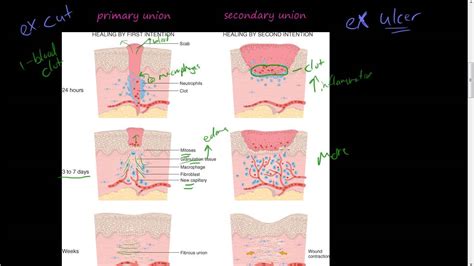 Scar Healing By Secondary Intention At Norman Nelson Blog