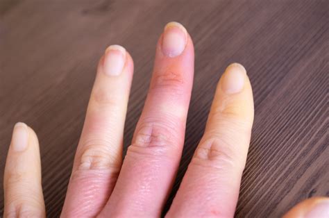 Scleroderma Diagnosis And Treatment