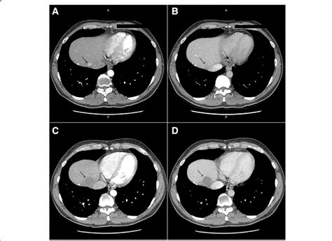 A And B Computed Tomography Abdominal Scan Hepatocellular Carcinoma Download Scientific