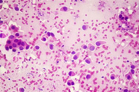 Microscopic Image Of Breast Cancer With Capillary Arrangement Stock