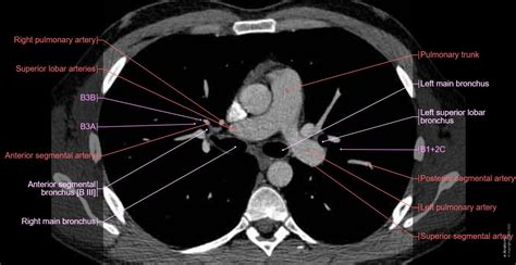 Anatomy Of The Lungs Mediastinum And Heart In Axial Slice E Anatomy