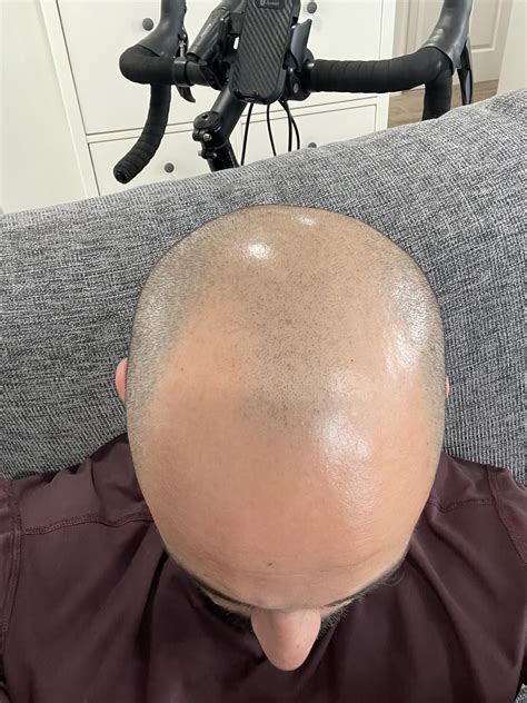 Vegeta Hairline Rbald