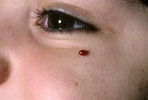 Pyogenic Granuloma Picture Image On