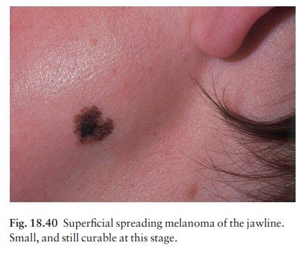 Superficial Spreading Melanoma Face