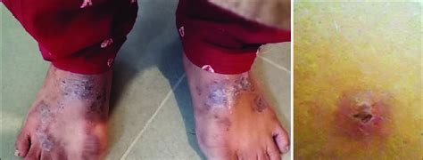 A Footwear Dermatitis B Positive Patch Test Result 3 To MBT B A Download Scientific