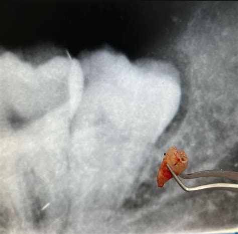 Dr Irfanullah Alwani On Linkedin 3rd Molar Disto Angular Impaction Extraction 🤓