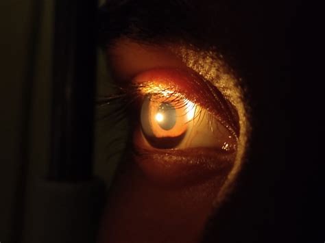 Importance Of Slit Lamp In Optometry Practice