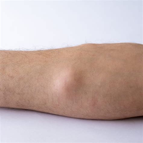 Cyst Vs Lipoma How To Tell The Difference And When To See A Specialist