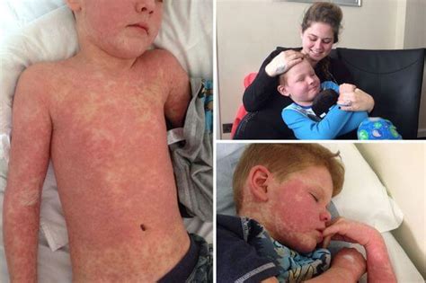 Penyakit Steven Johnson Syndrome Yang Perlu Anda Wasp