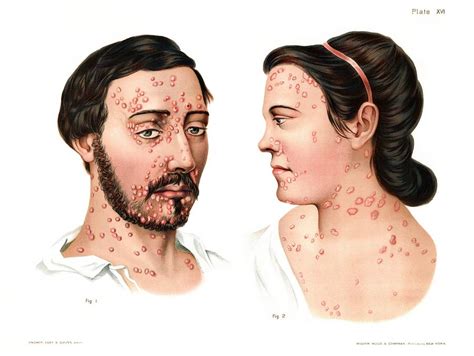 Syphilis Rash On Arms
