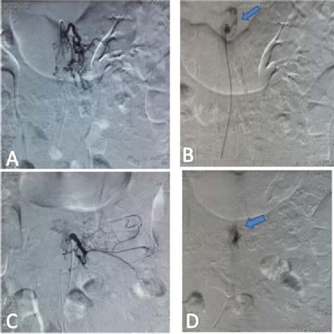 Preoperative Embolization A T12 Before Embolization B T12 After