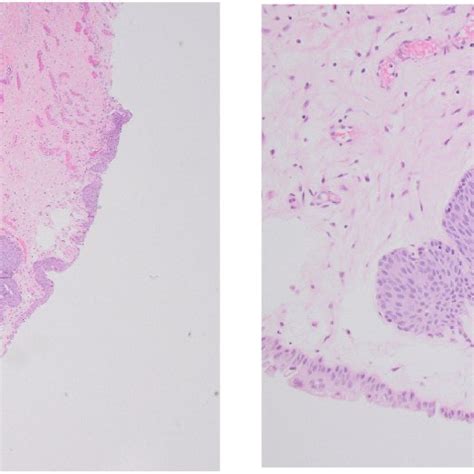 Ultrasound Imaging Of Urethral Polyp At Time Of Presentation Sagittal