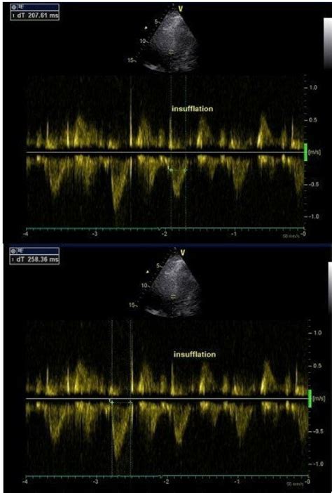 Lvot Pulsed Doppler Flow With And Without Insufflation In A