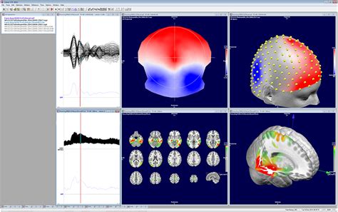 Frontiers Eeg Source Imaging A Practical Review Of The Analysis Steps