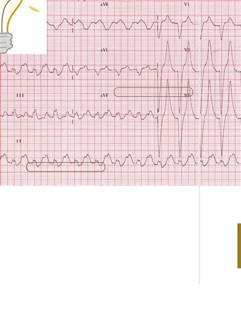 Hyperkalemia And Hypokalemia Notes Diagrams And Illustrations Osmosis