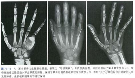 手部骨良性肿瘤 知乎