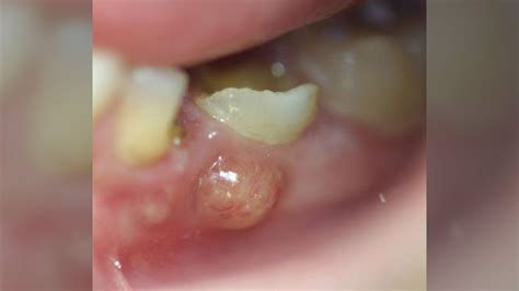 Gum Boil