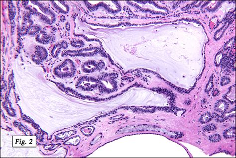 May 2012 A 79 Year Old Woman With An Inner Cheek Mass California