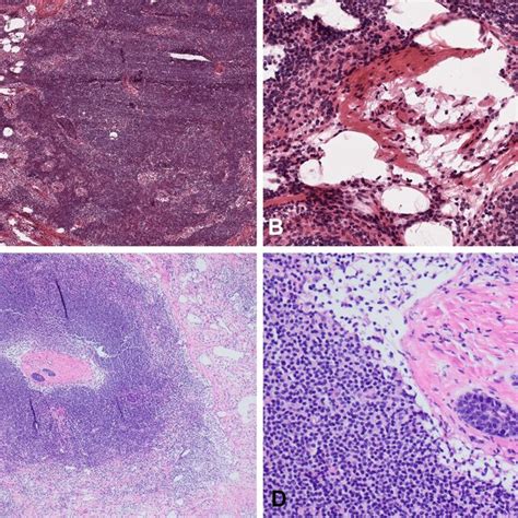 Axillary Sentinel Lymph Node Assessed Via Telepathology From Patient 7 Download Scientific