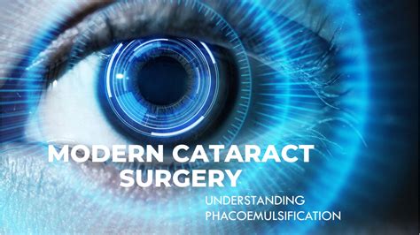 Understanding Phacoemulsification Modern Cataract Surgery