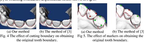 Figure 4 From Interactive Tooth Segmentation Method Of Dental Model