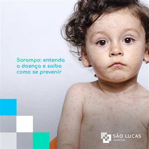 O Sarampo é Uma Doença Infecciosa Hospital Especializado