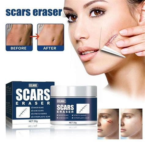 Do Eraser Burn Scar At Mamie Jones Blog