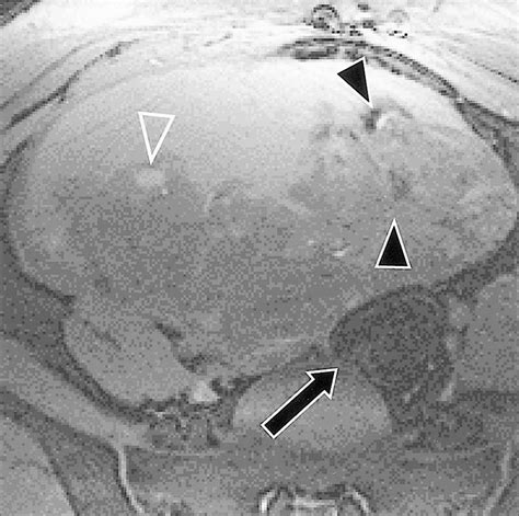 Ovarian Teratomas Tumor Types And Imaging Characteristics Radiographics