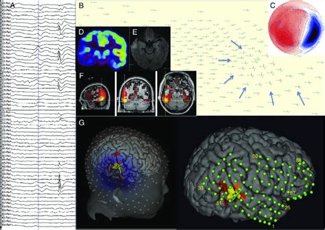 Case NO A Interictal Epileptic Discharges Recorded By IcEEG Are Download Scientific Diagram