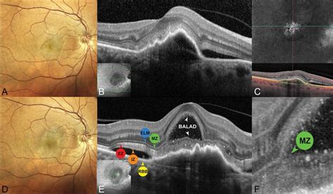 Bacillary Layer Detachment Associated With Exudative Neovascular Amd Download Scientific