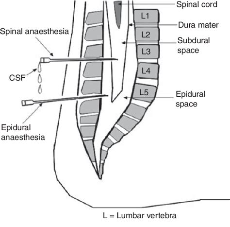 Spinal Block Vs Epidural Nursing At Quentin Sanchez Blog