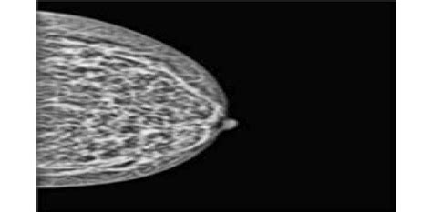 clahe enhanced mammogram download scientific diagram