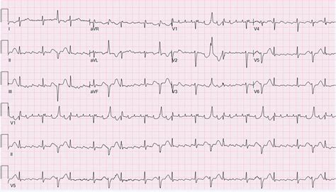 Twelve Lead Ecg Of Atrial Flutter With Varying Conduction Download