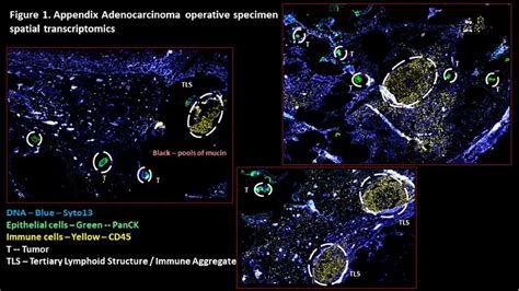 Utilizing Spatial Transcriptomics To Define Potential Biomarkers Of Immune Checkpoint