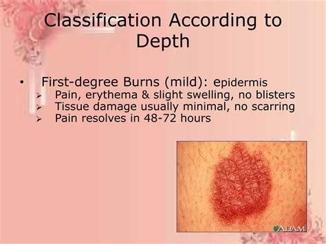 Nursing Management Of Burns Pptx