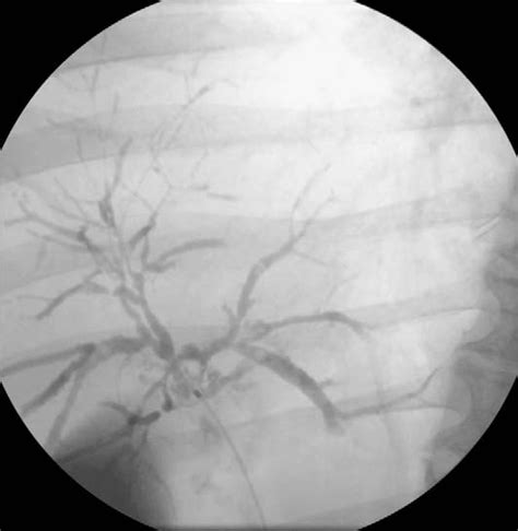 Figure From Sclerosing Cholangitis Primary Intrahepatic And Extrahepatic Intrahepatic