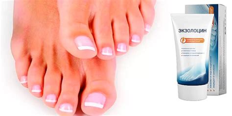«ЭКЗОЛОЦИН от грибка ногтей реальные отзывы купить в аптеке цена развод