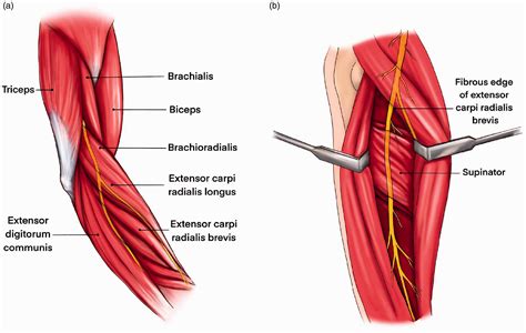 Radial Nerve Entrapment