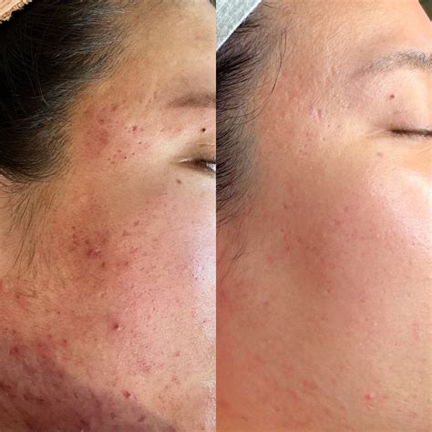 슈퍼젝션 논산 모아르” 대표 송화정 논산피부관리 대전슈퍼젝션 파메스테틱 홈케어코칭 흉터치료 하다하다 지쳐 포기하셨나요 여러 치료로 예민해져만 가는 내피부 되돌릴