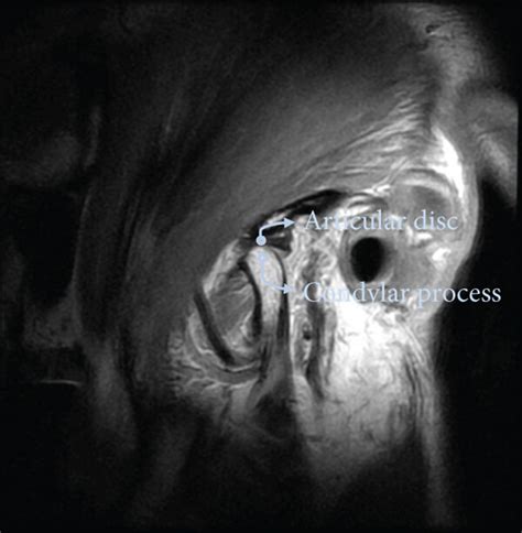 Magnetic Resonance Imaging Mri Of The Temporomandibular Joints Download Scientific Diagram