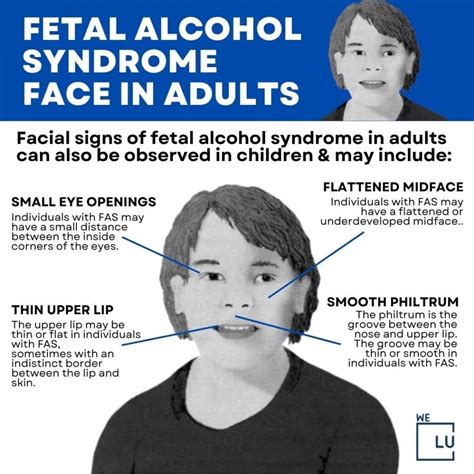 Fetal Alcohol Syndrome In Adulthood