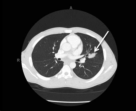 Computed Tomography Chest Scan Showing Multiple Bilateral Download Scientific Diagram