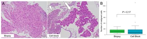 The Comparison Of Malignant Cell Count On The Cell Block Cb And