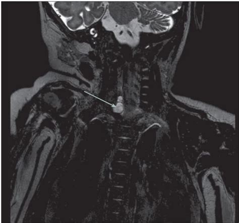 Diagnosis Of Roo Česká A Slovenská Neurologie A Neurochirurgie