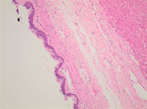 Histological Sample Of Ciliated Hepatic Foregut Cyst With Hematoxylin