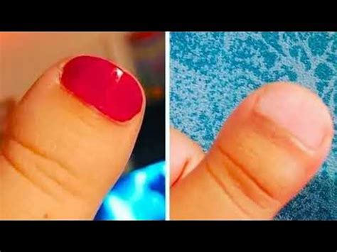 About Clubbed Thumbs Wide Nail Bed Brachydactyly Type D Toethumbs
