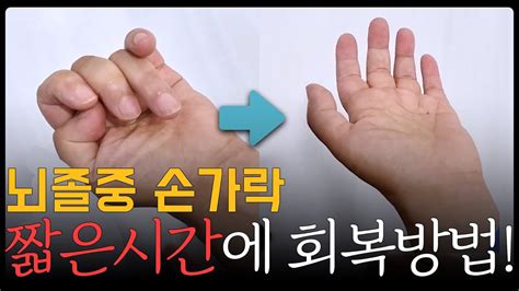 펴지지않던 손가락이 짧은시간에 펼 수 있었던 이유 운동방법 Youtube