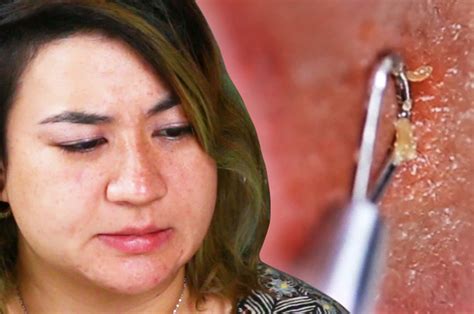 We Tried Pimple Extractors And It Was Grossly Satisfying