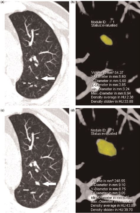 New Pulmonary Nodule In The Apicoposterior Segment Of The Left Superior